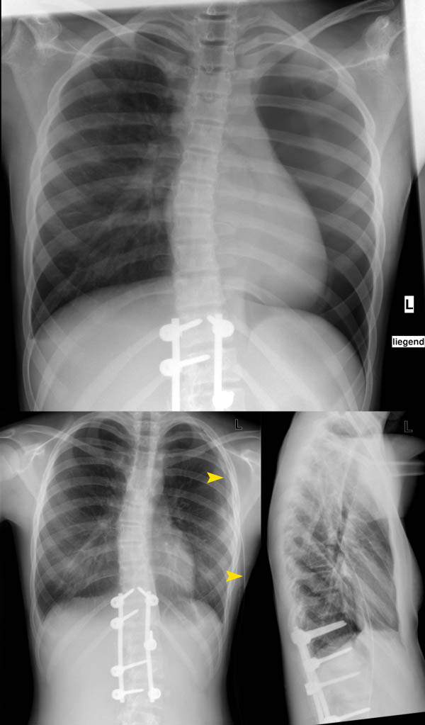 Thoraxapertur Rare Diseases Of Larynx, Trachea And Thyroid. Abstract